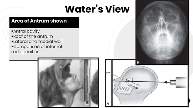 Maxillary sinus imaging | PPTX | Ear, Nose and Throat Conditions ...
