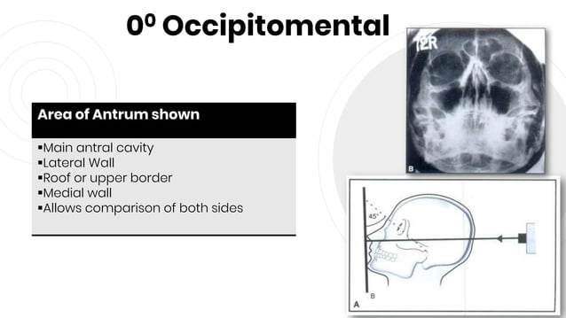 Maxillary sinus imaging | PPTX | Ear, Nose and Throat Conditions ...