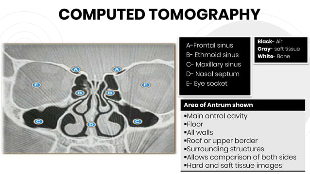 Maxillary sinus imaging | PPTX | Ear, Nose and Throat Conditions ...