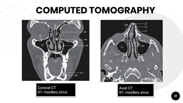 Maxillary sinus imaging | PPTX | Ear, Nose and Throat Conditions ...