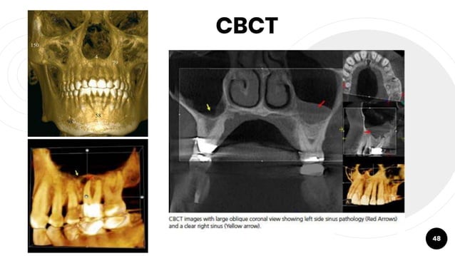 Maxillary sinus imaging | PPTX | Ear, Nose and Throat Conditions ...