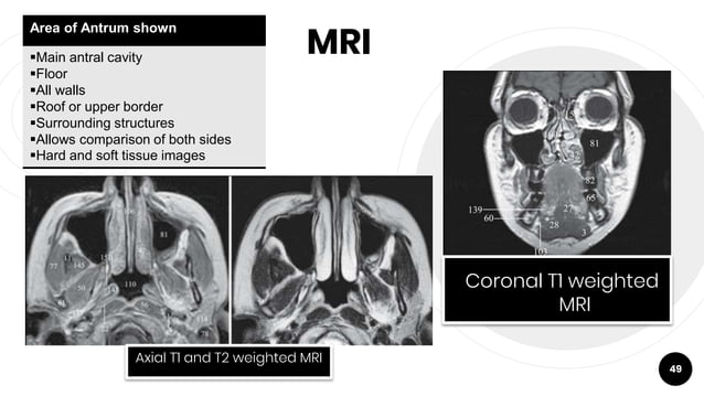 Maxillary sinus imaging | PPTX | Ear, Nose and Throat Conditions ...