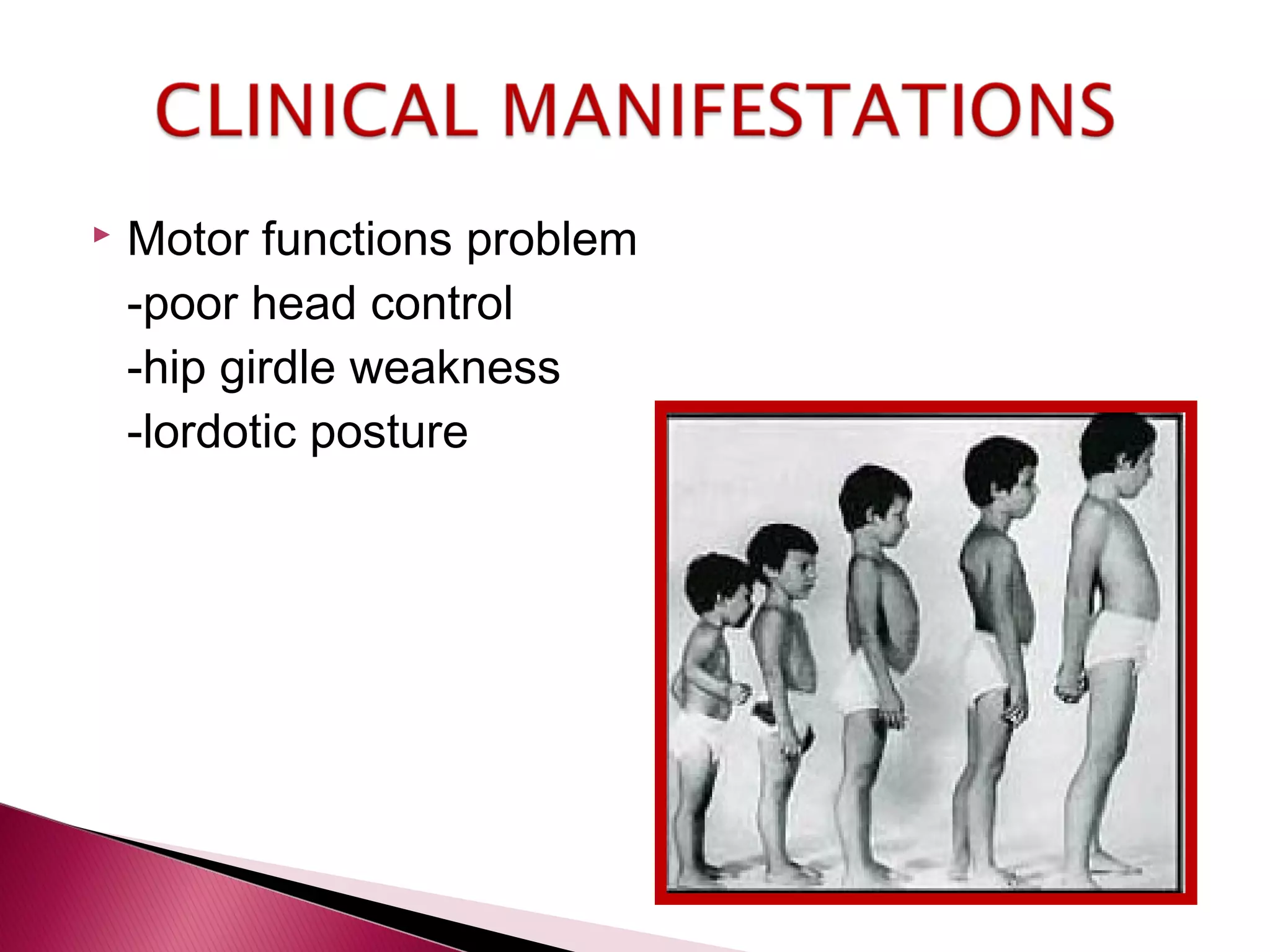Muscle Dystrophy | PPT
