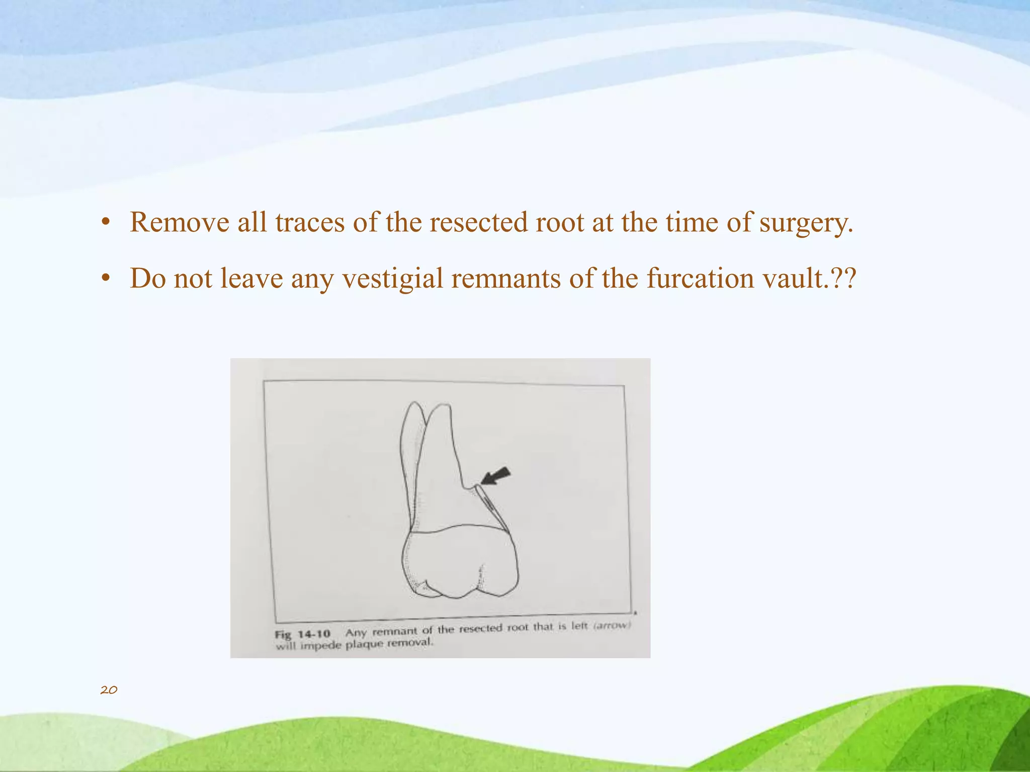 Preparation of periodontally weakened teeth | PPTX
