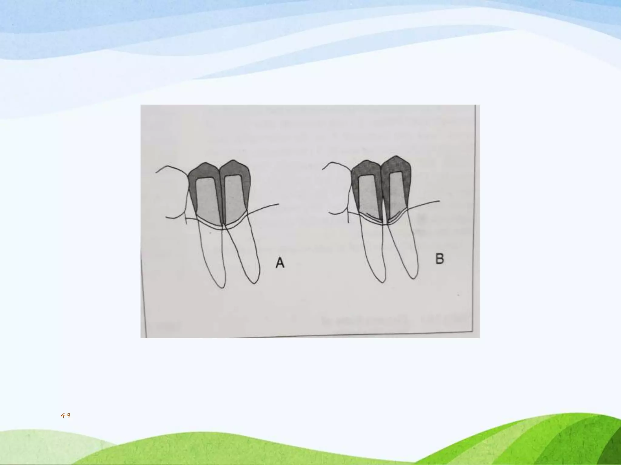 Preparation of periodontally weakened teeth | PPTX