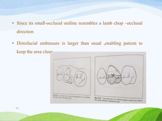 Preparation of periodontally weakened teeth | PPTX