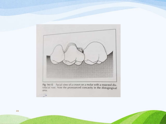 Preparation of periodontally weakened teeth | PPTX | Dental Health ...