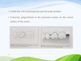 Preparation of periodontally weakened teeth | PPTX