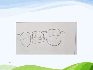 Preparation of periodontally weakened teeth | PPTX