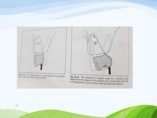 Preparation of periodontally weakened teeth | PPTX | Dental Health ...