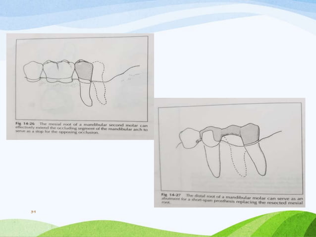 Preparation of periodontally weakened teeth | PPTX | Dental Health ...