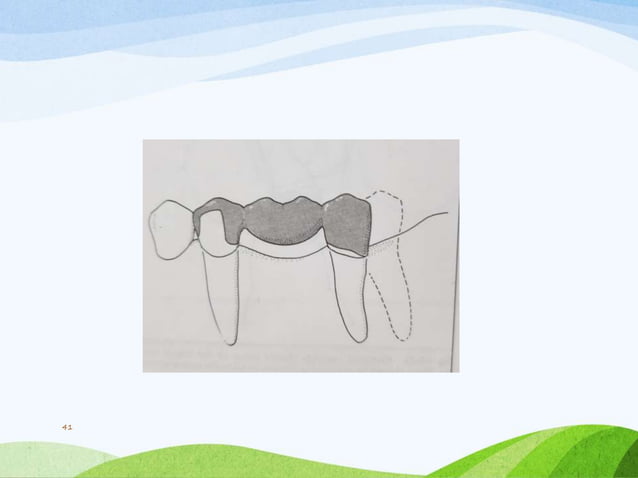 Preparation of periodontally weakened teeth | PPTX | Dental Health ...