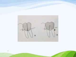 Preparation of periodontally weakened teeth | PPTX