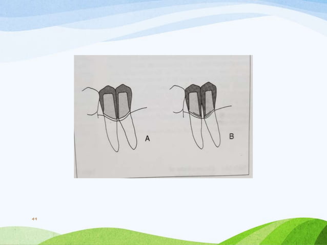 Preparation of periodontally weakened teeth | PPTX | Dental Health ...