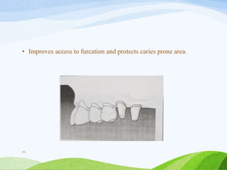 Preparation of periodontally weakened teeth | PPTX