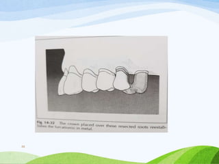 Preparation of periodontally weakened teeth | PPTX