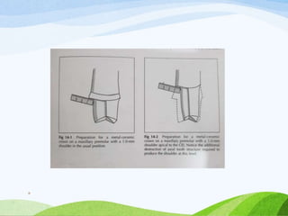 Preparation of periodontally weakened teeth | PPTX