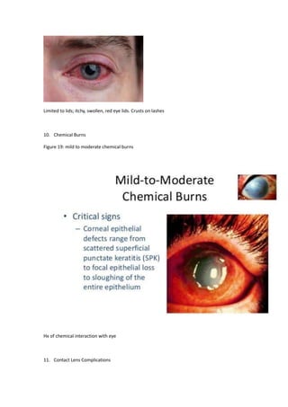 Seminar on Bacterial conjunctivitis .docx