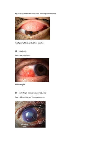 Seminar on Bacterial conjunctivitis .docx