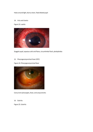 Seminar on Bacterial conjunctivitis .docx