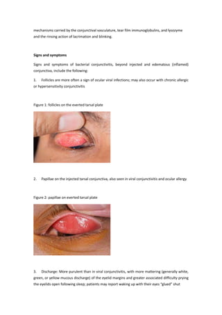 Seminar on Bacterial conjunctivitis .docx