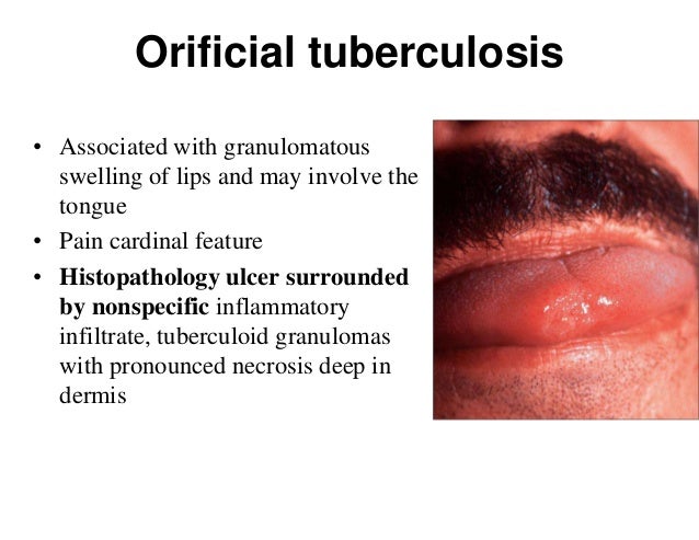 Cutaneous Tuberculosis – Cutaneous tuberculosis: diagnosis and ...
