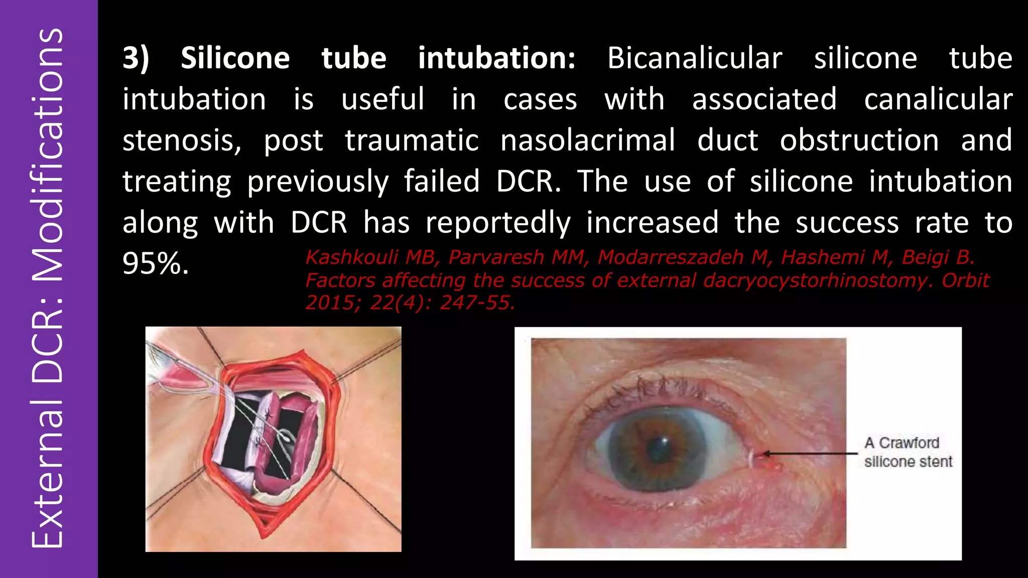 Dacrocystitis: Diagnosis and Management | PPTX