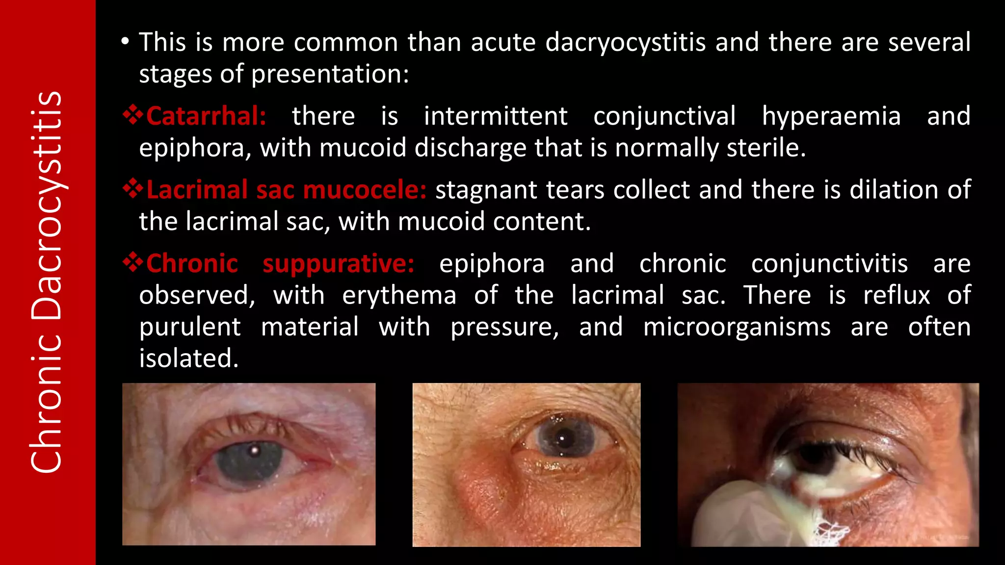 Dacrocystitis: Diagnosis and Management | PPTX
