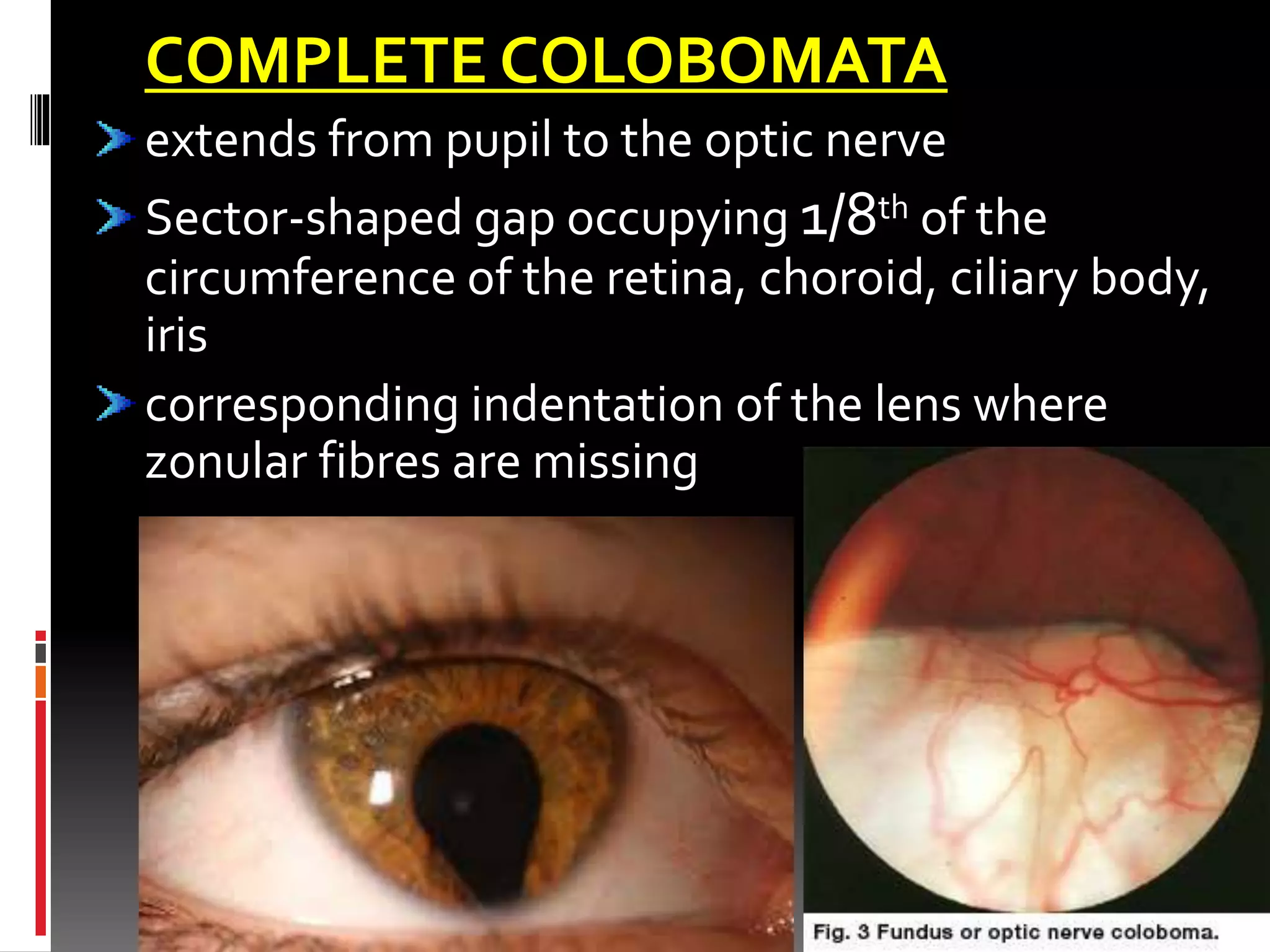 ANATOMY OF IRIS AND ITS CONGENITAL ANOMALIES | PPTX