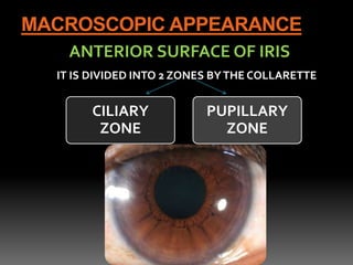 ANATOMY OF IRIS AND ITS CONGENITAL ANOMALIES | PPTX