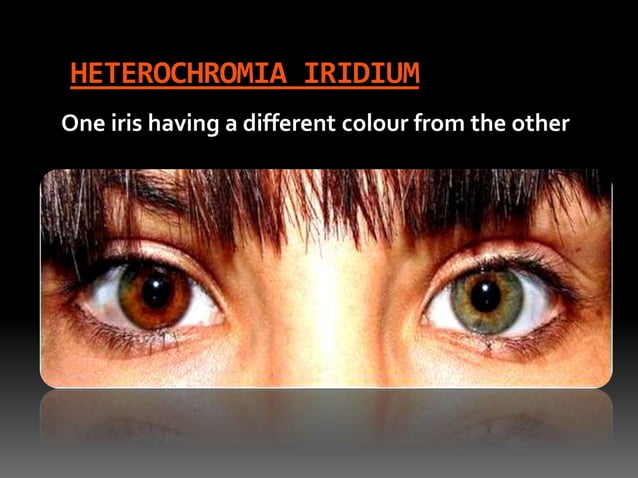 ANATOMY OF IRIS AND ITS CONGENITAL ANOMALIES | PPTX | Eye and Vision ...