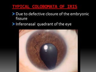 ANATOMY OF IRIS AND ITS CONGENITAL ANOMALIES | PPTX