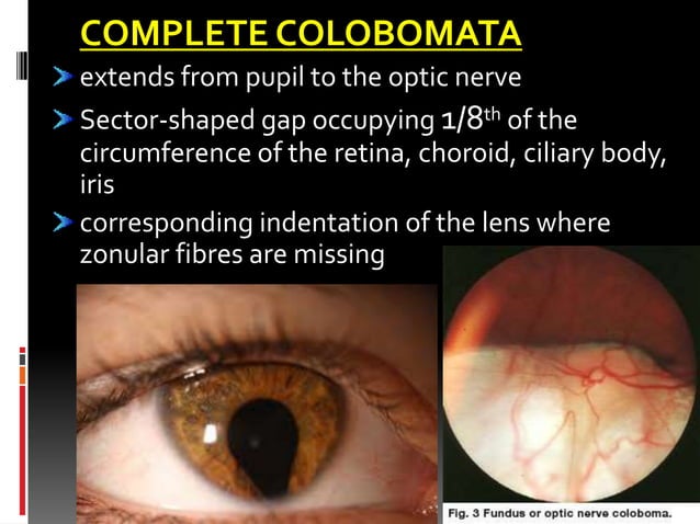 ANATOMY OF IRIS AND ITS CONGENITAL ANOMALIES | PPTX | Eye and Vision ...