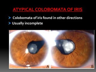ANATOMY OF IRIS AND ITS CONGENITAL ANOMALIES | PPTX