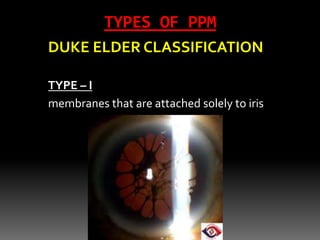 ANATOMY OF IRIS AND ITS CONGENITAL ANOMALIES | PPTX