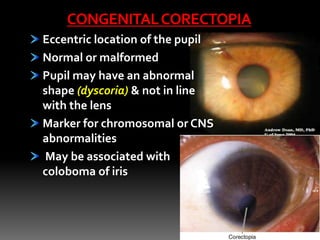 ANATOMY OF IRIS AND ITS CONGENITAL ANOMALIES | PPTX