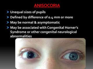 ANATOMY OF IRIS AND ITS CONGENITAL ANOMALIES | PPTX