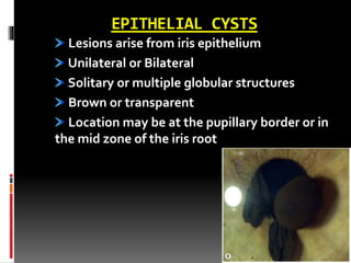 ANATOMY OF IRIS AND ITS CONGENITAL ANOMALIES | PPTX