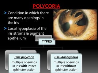 ANATOMY OF IRIS AND ITS CONGENITAL ANOMALIES | PPT
