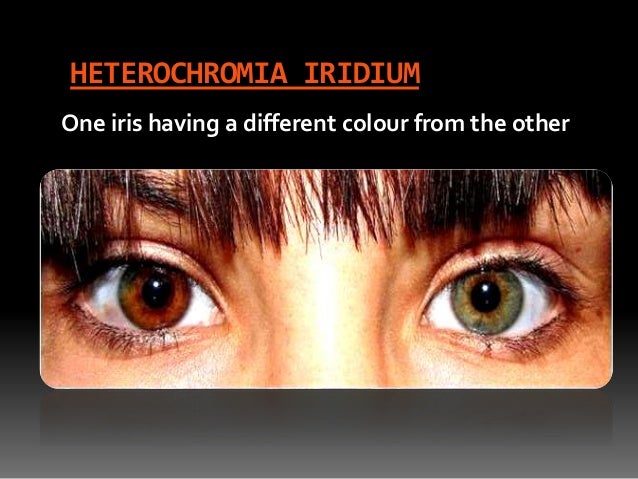 ANATOMY OF IRIS AND ITS CONGENITAL ANOMALIES