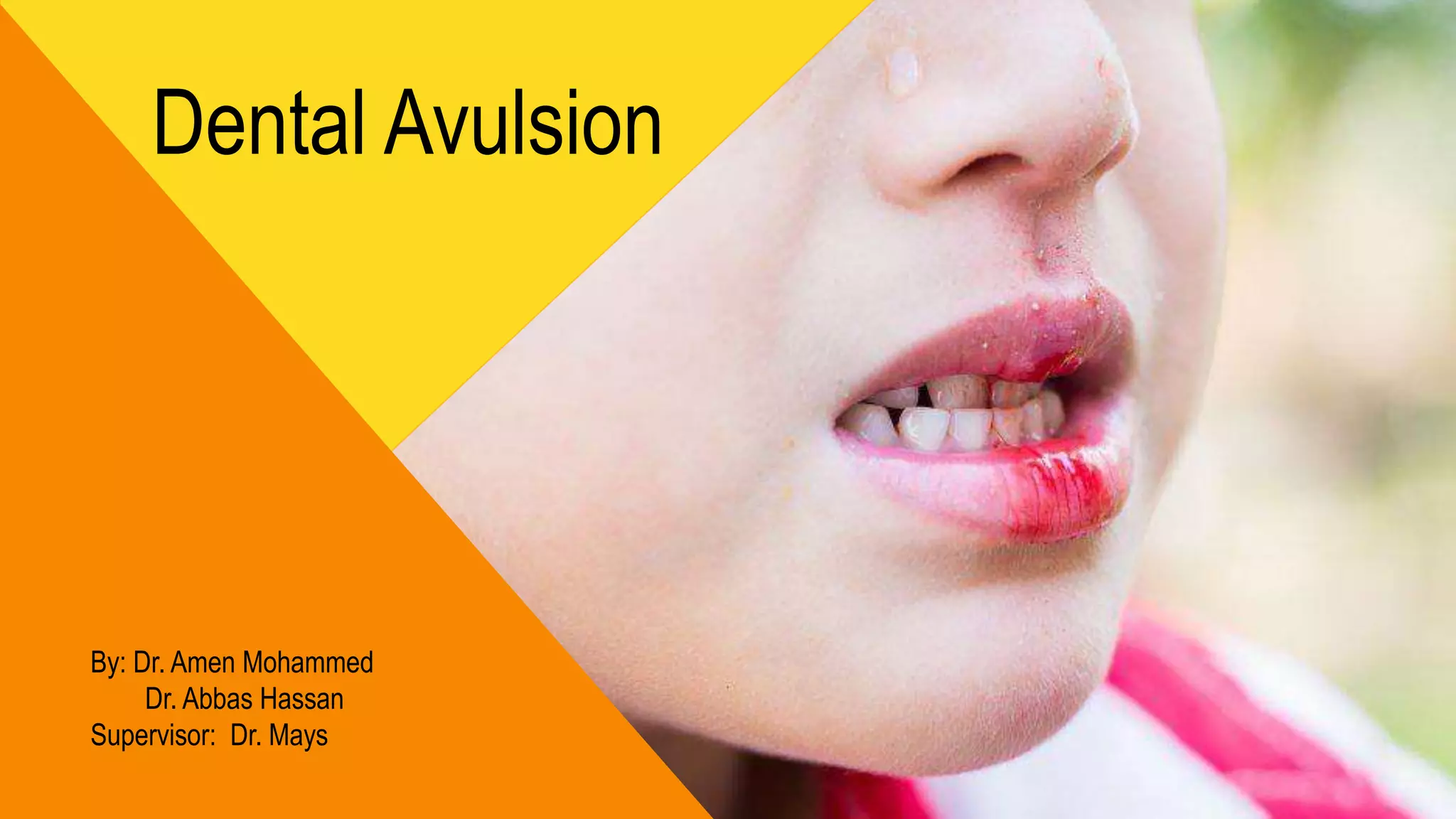 dental avulsion.pptx