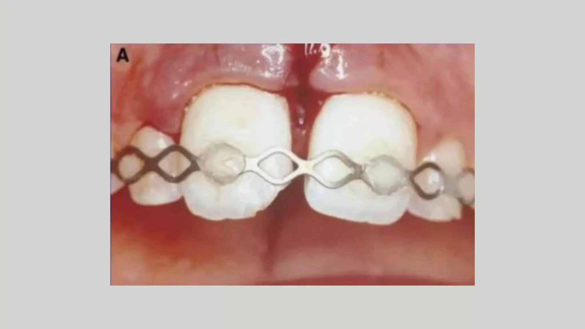 dental avulsion.pptx