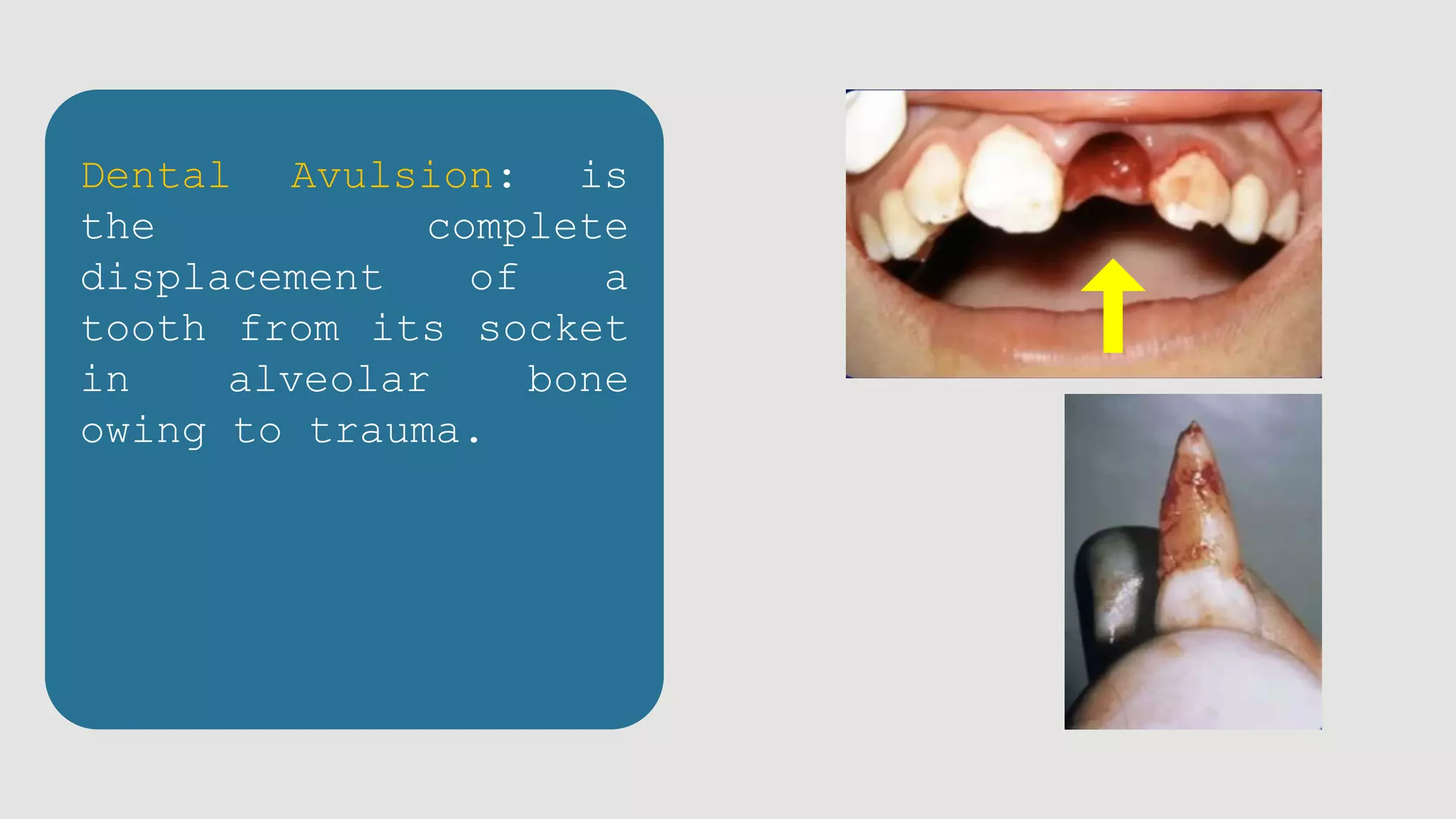 dental avulsion.pptx