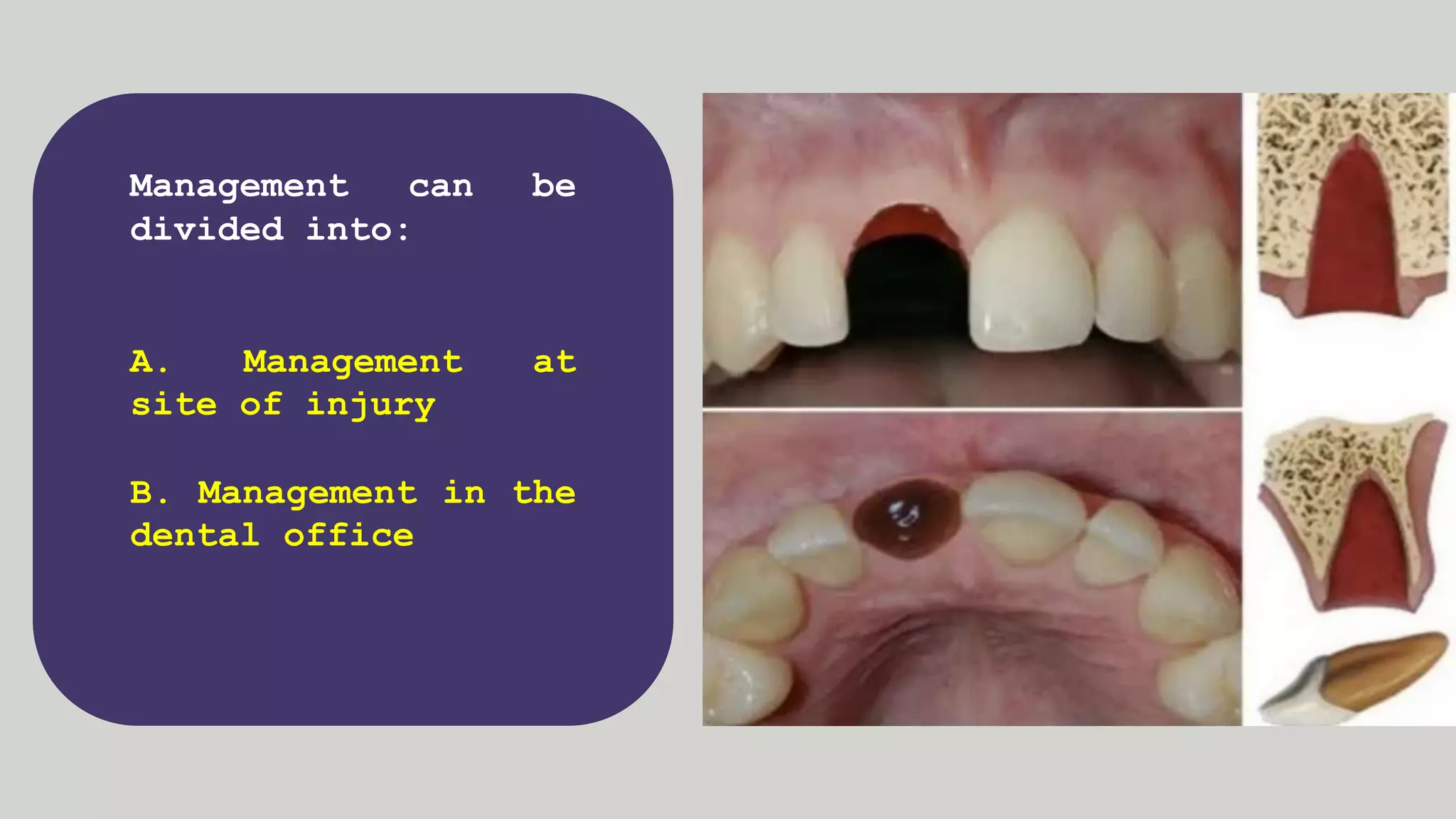 dental avulsion.pptx