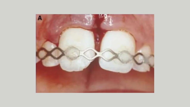 dental avulsion.pptx | Dental Health | Diseases and Conditions