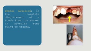 dental avulsion.pptx