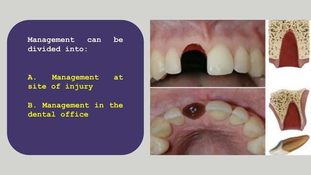 dental avulsion.pptx | Dental Health | Diseases and Conditions