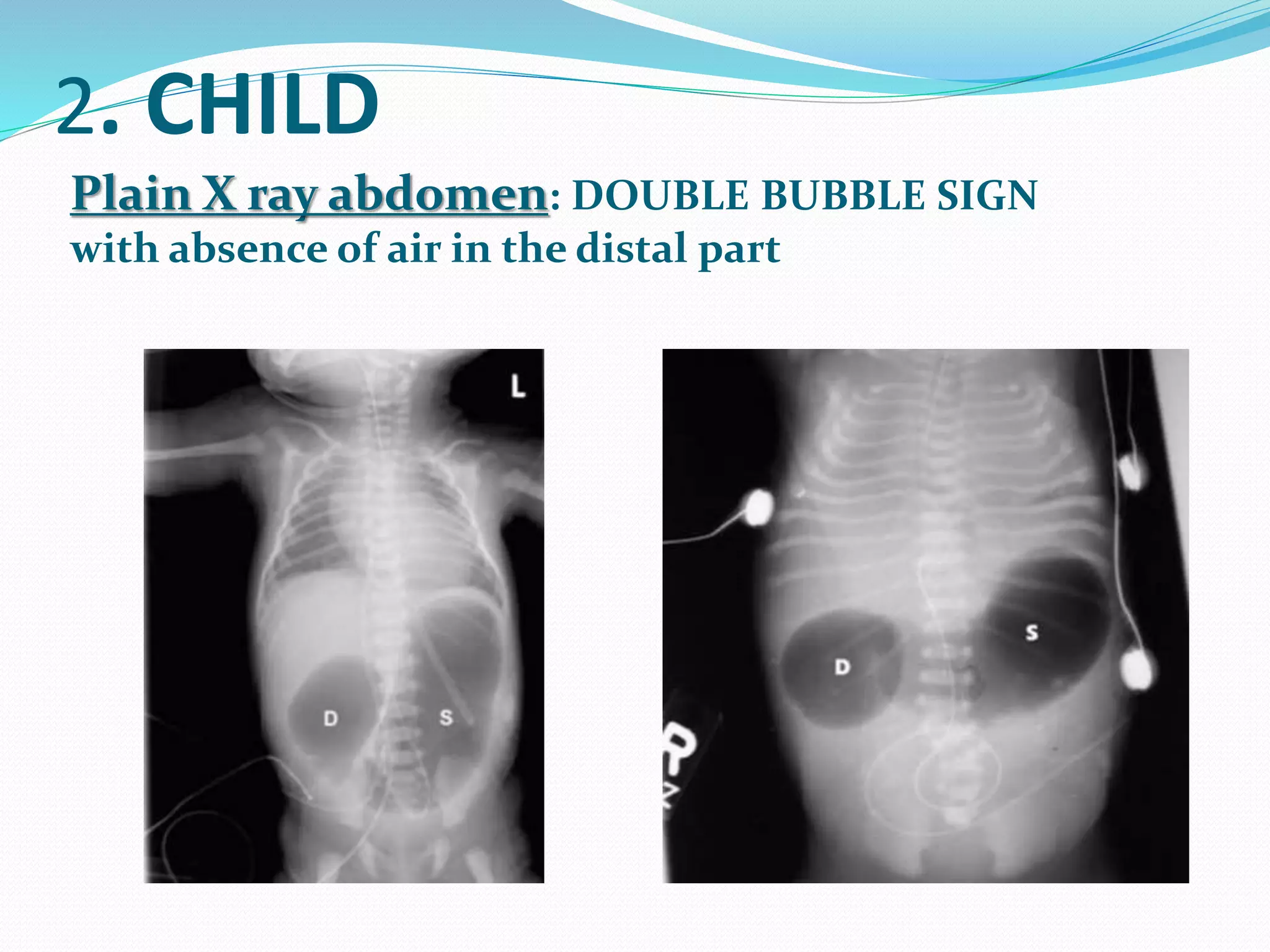 duodenal atresia | PPTX