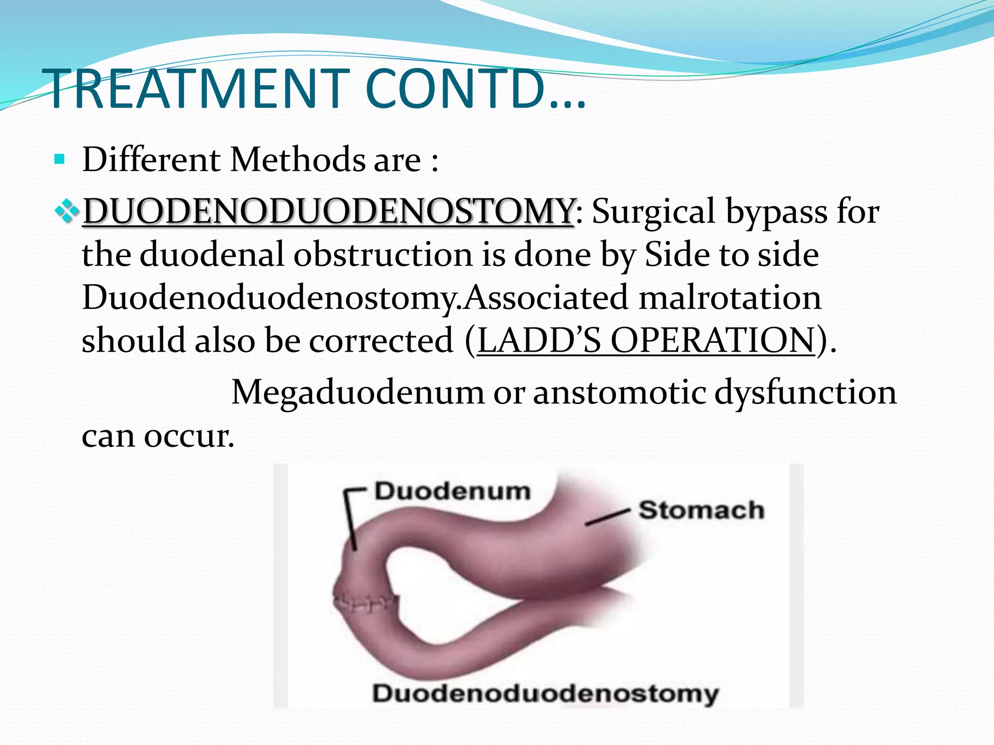 duodenal atresia | PPTX