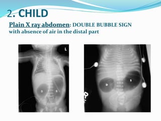 Duodenal Atresia X Ray